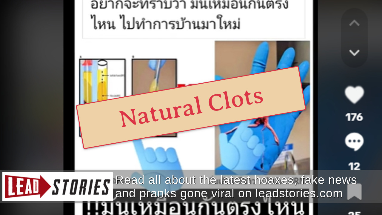 Fact Check: White Clots Are NOT Linked To mRNA Vaccines | Lead Stories